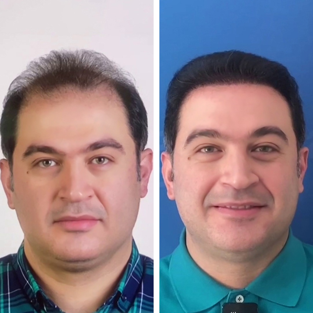 High Density Hair Transplant In Istanbul HD Hair Transplantation high-density-hair-transplant-in-istanbul-hd-hair-transplantation