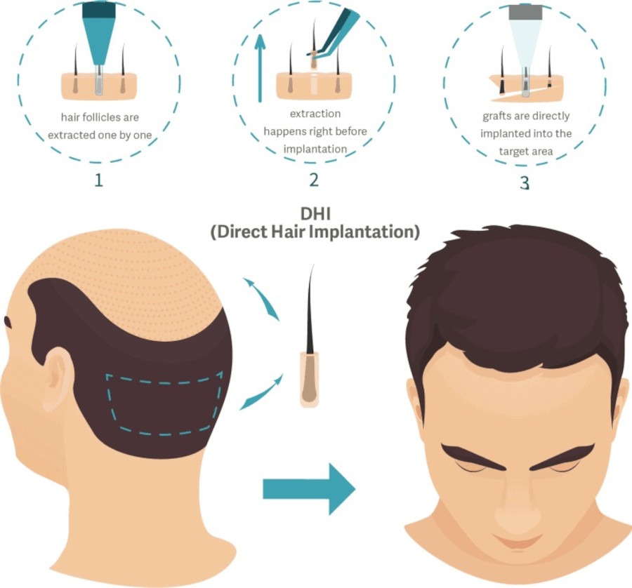 DHI hair transplant in Istanbul - Best Prices - Rahya Health Tourism